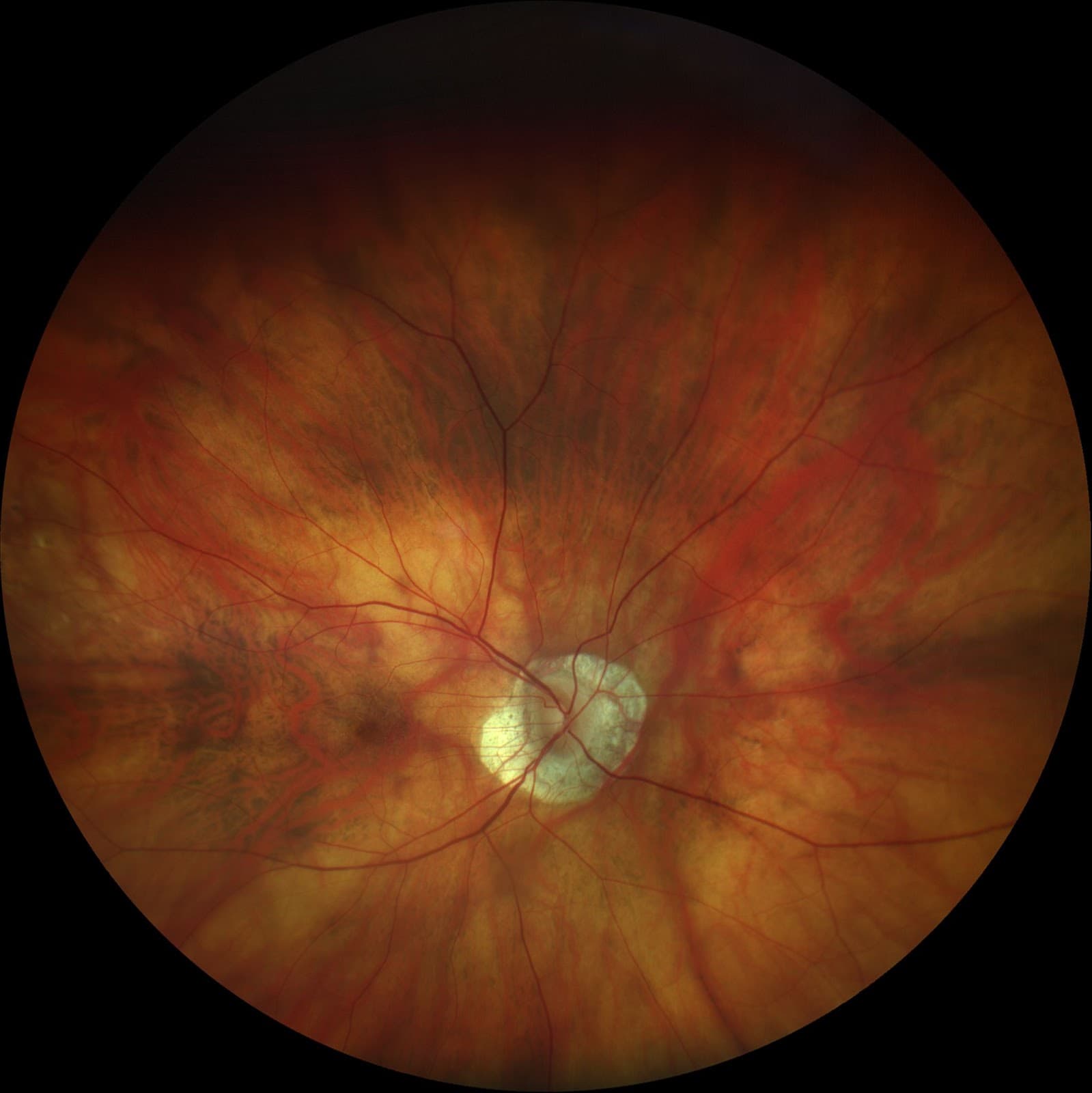Managing Glaucoma with an Integrated Diagnostic Ecosystem