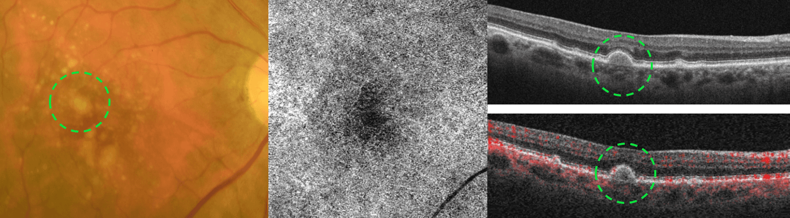 The Benefits of OCT Angiography for Ocular Disease Diagnosis