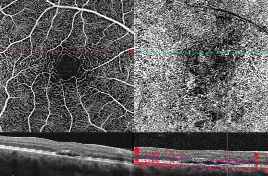 The Benefits of OCT Angiography for Ocular Disease Diagnosis