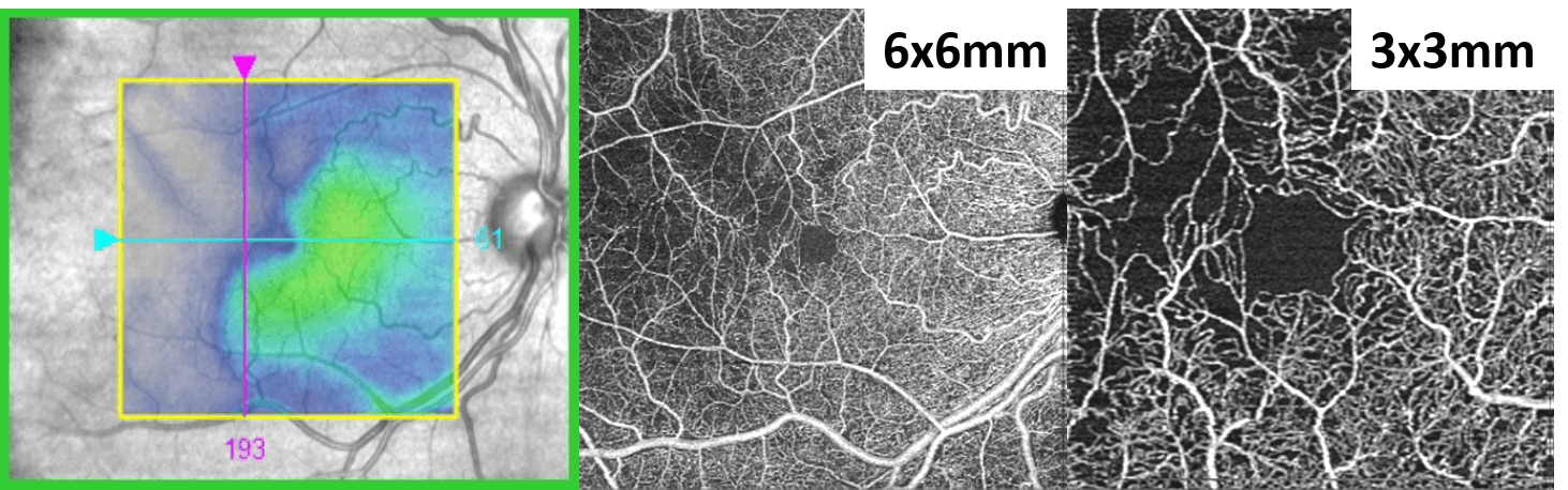 The Benefits of OCT Angiography for Ocular Disease Diagnosis