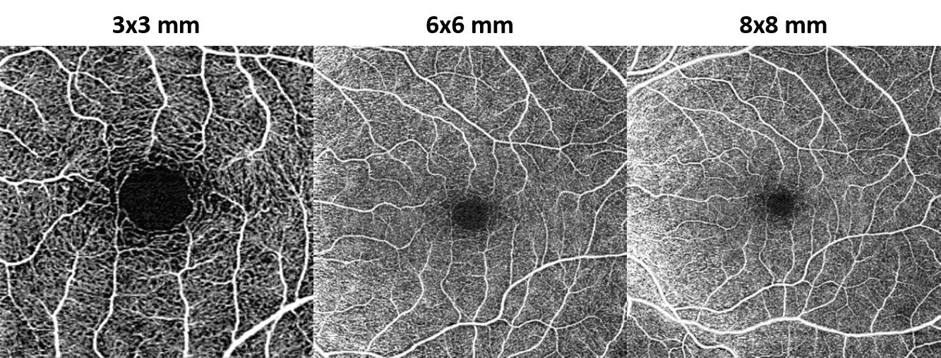 The Benefits of OCT Angiography for Ocular Disease Diagnosis
