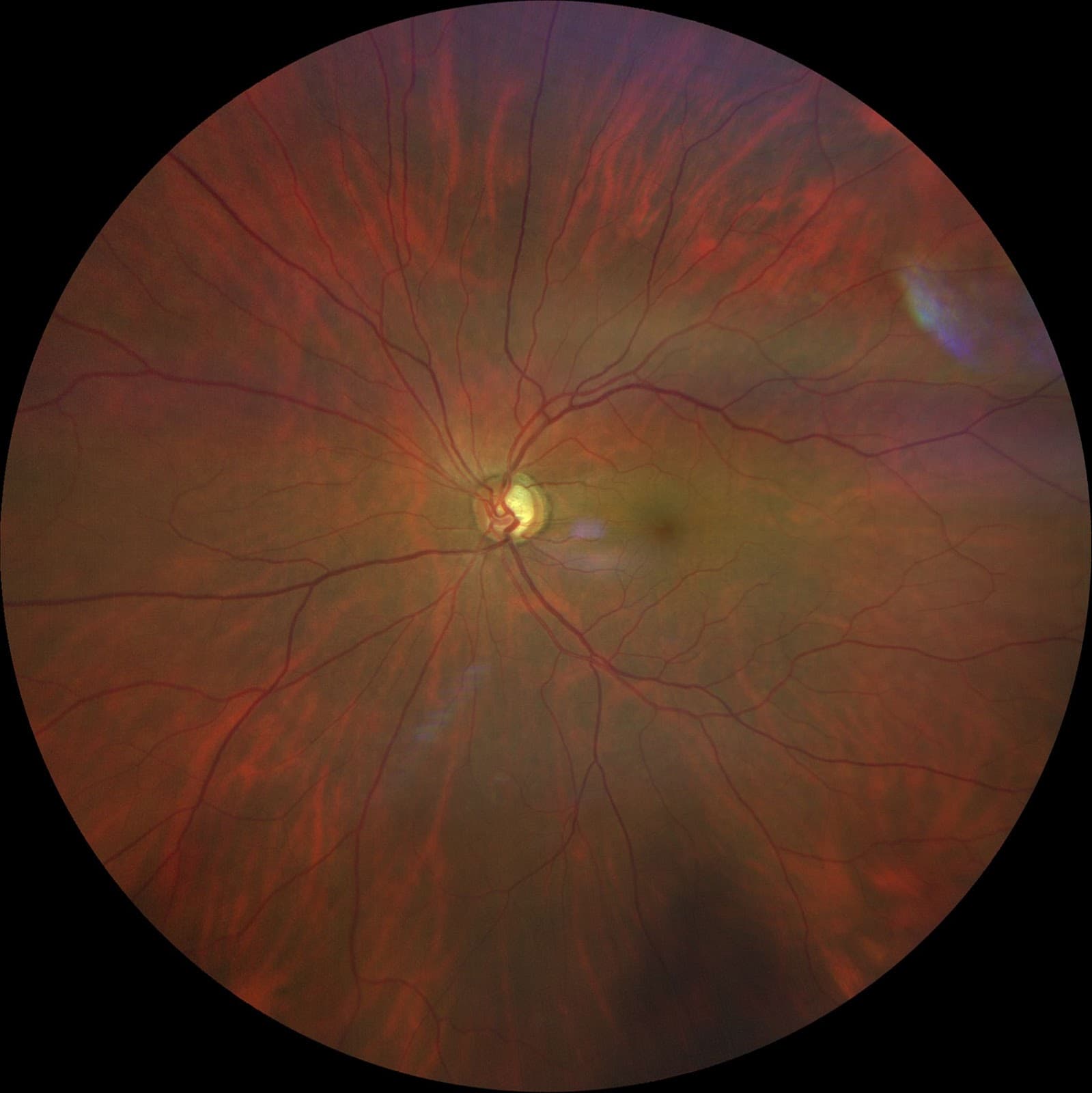 Managing Glaucoma with an Integrated Diagnostic Ecosystem