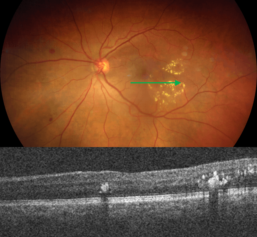 Pathogenesis, Classification, and Treatment of Diabetic Retinopathy