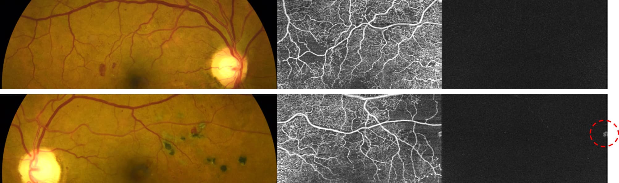 OCT Angiography: A New Perspective on Diabetic Retinopathy
