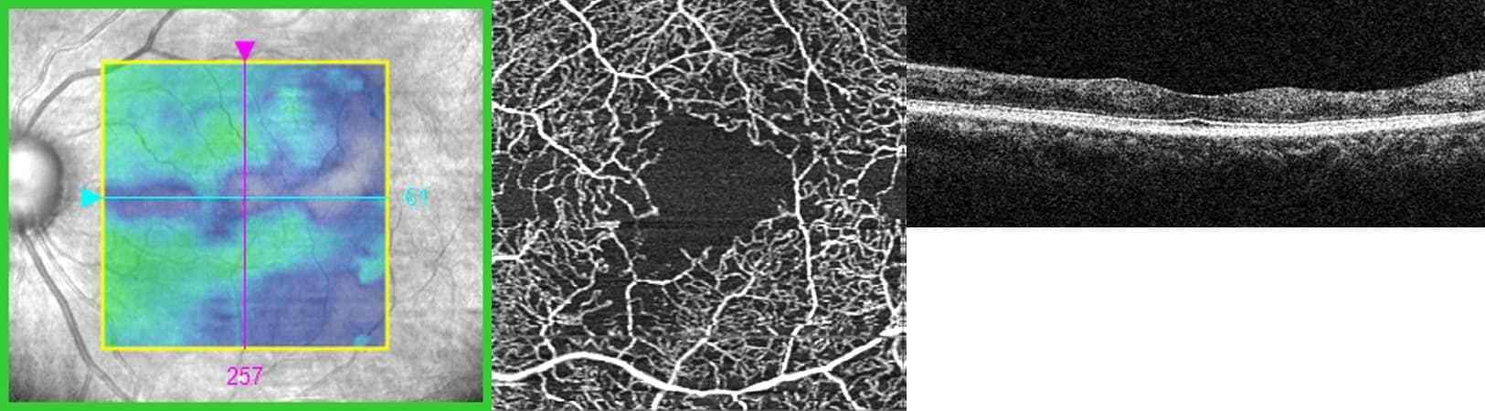 OCT Angiography: A New Perspective on Diabetic Retinopathy