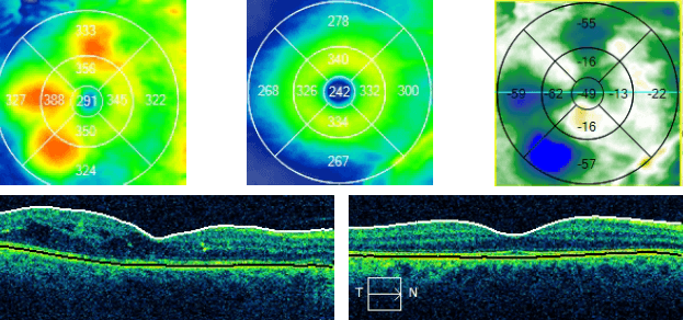 Pathogenesis, Classification, and Treatment of Diabetic Retinopathy