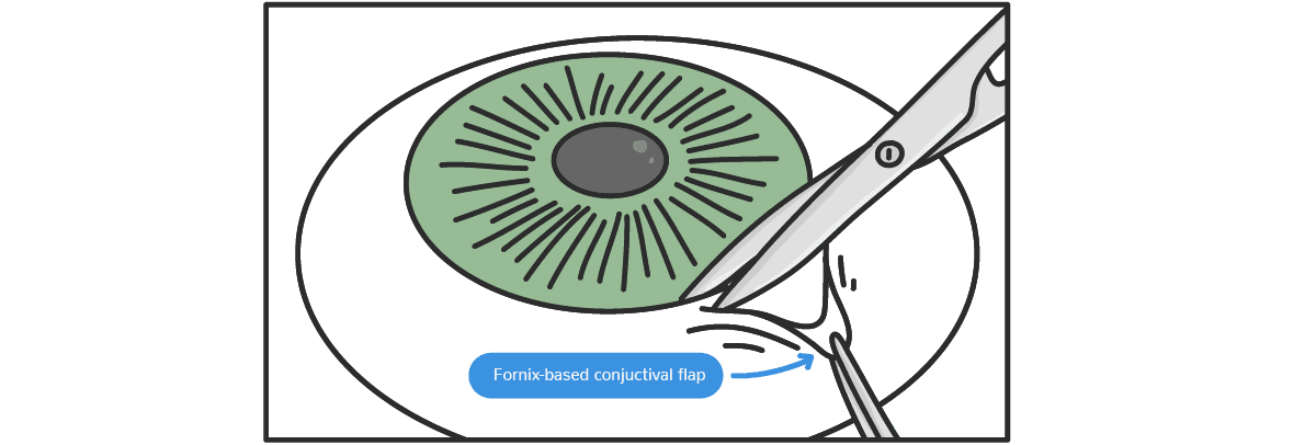 The Ultimate Guide to Glaucoma Surgery