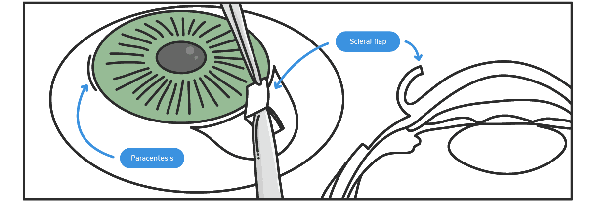 The Ultimate Guide to Glaucoma Surgery