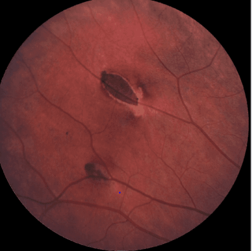 Differential Diagnosis for a Pigmented Fundus Lesion with Downloadable ...