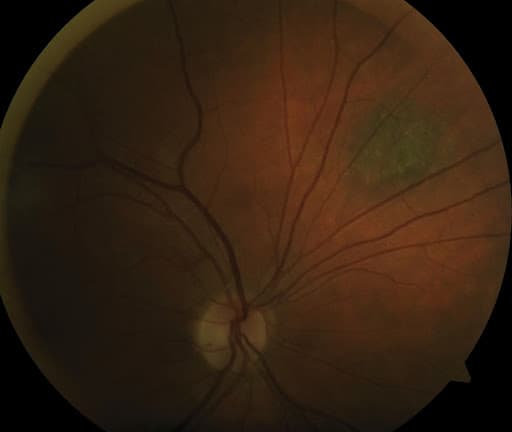 Suspicious Choroidal Lesions: Identifying Melanoma