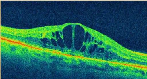 Guide to Common Macula Findings with OCT with Downloadable Cheat Sheet