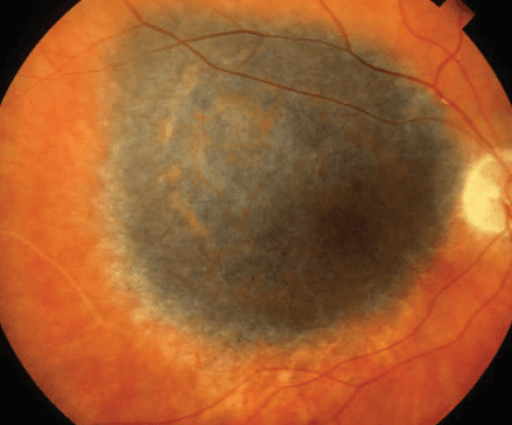 Differential Diagnosis for a Pigmented Fundus Lesion with Downloadable ...