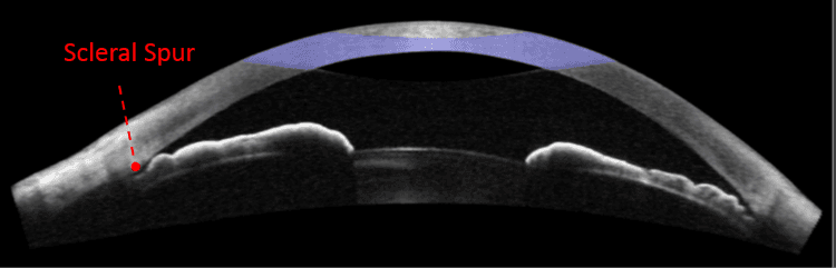 Utilizing OCT for Glaucoma Diagnosis and Management