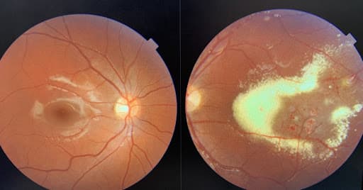 What You Need to Know about Coats Disease