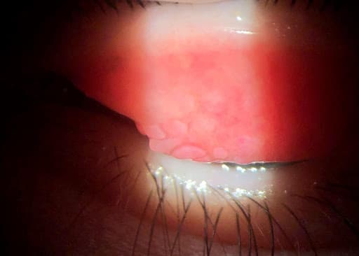 The Ultimate Guide to Conjunctivitis Differential Diagnosis