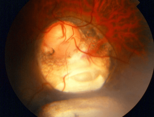 Differential Diagnosis for a Pigmented Fundus Lesion with Downloadable ...
