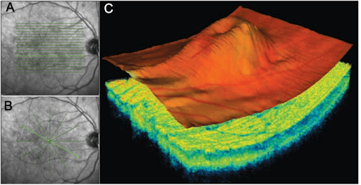 Guide to Common Macula Findings with OCT with Downloadable Cheat Sheet