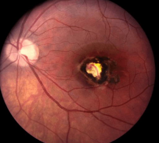 Differential Diagnosis for a Pigmented Fundus Lesion with Downloadable ...