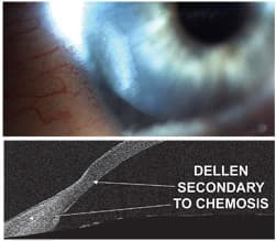 Treating Corneal Dellen with Bandage Contact Lenses