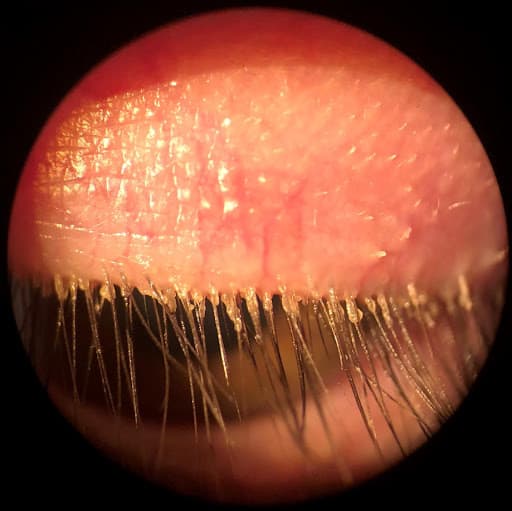 The Ultimate Guide to Demodex Blepharitis