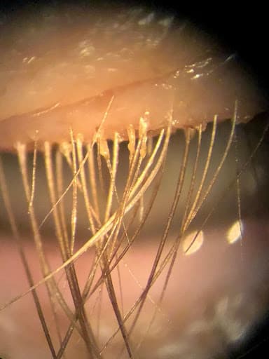 The Ultimate Guide to Demodex Blepharitis
