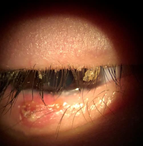The Ultimate Guide To Demodex Blepharitis