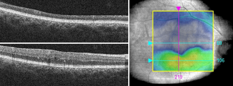 Pathogenesis, Classification, and Treatment of Diabetic Retinopathy