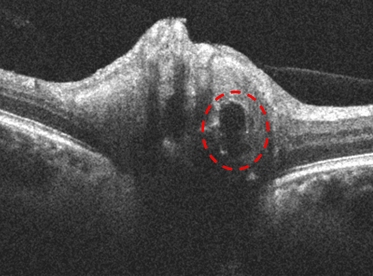 OCT of the Elevated Optic Nerve Head