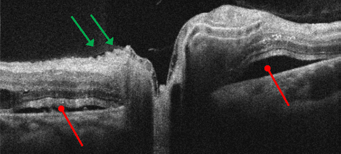 OCT of the Elevated Optic Nerve Head
