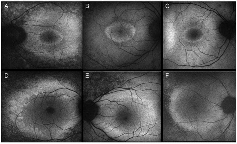 Putting The Fun In Fundus Autofluorescence (FAF)