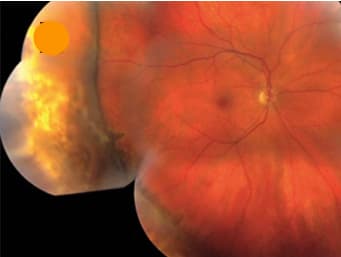 What Ophthalmology Residents Should Know About Retinal Detachment Repair