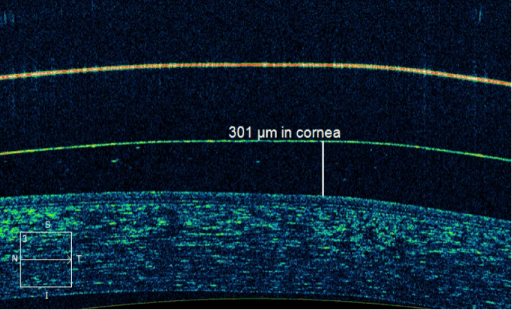 The Ultimate Guide to Scleral Lenses for Dry Eye