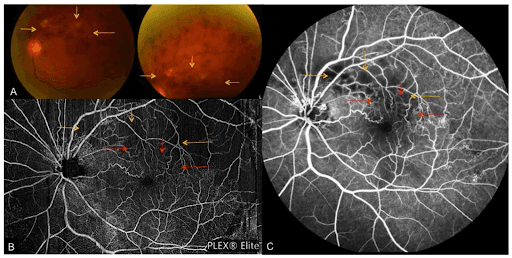 The OD’s Guide to OCT-A