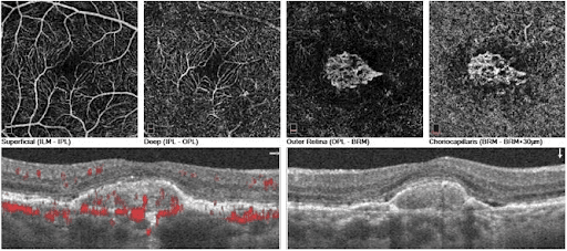 The OD’s Guide to OCT-A