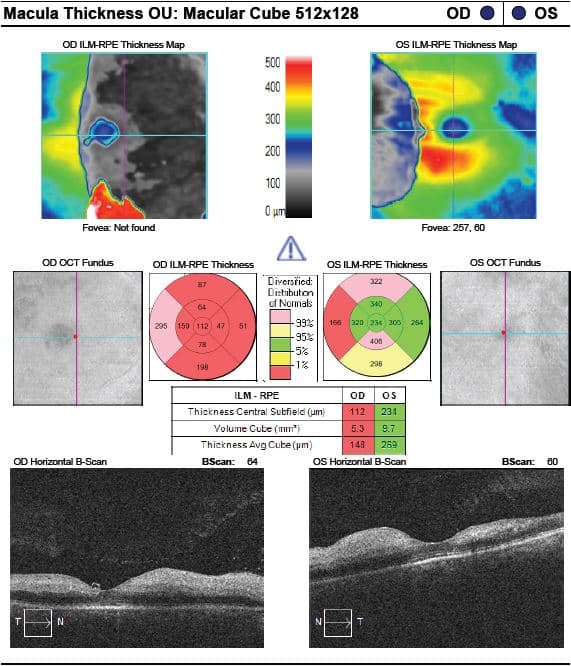 Ophthalmology Case Report: Simultaneous Bilateral Central Retinal ...