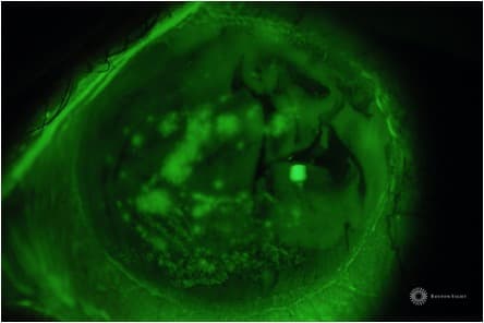 The Ultimate Guide to Scleral Lenses for Dry Eye