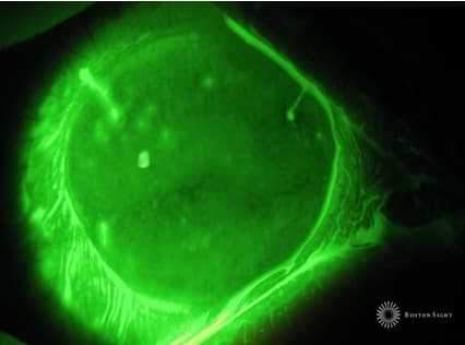 The Ultimate Guide to Scleral Lenses for Dry Eye