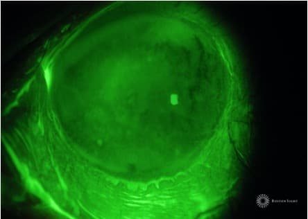 The Ultimate Guide to Scleral Lenses for Dry Eye
