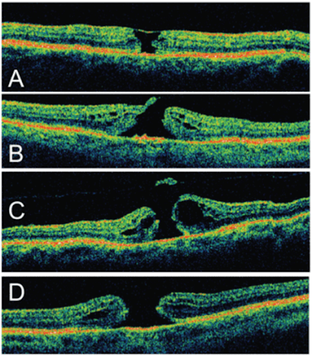 Guide to Common Macula Findings with OCT with Downloadable Cheat Sheet