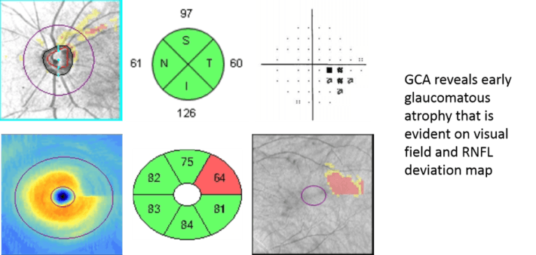 Utilizing OCT for Glaucoma Diagnosis and Management