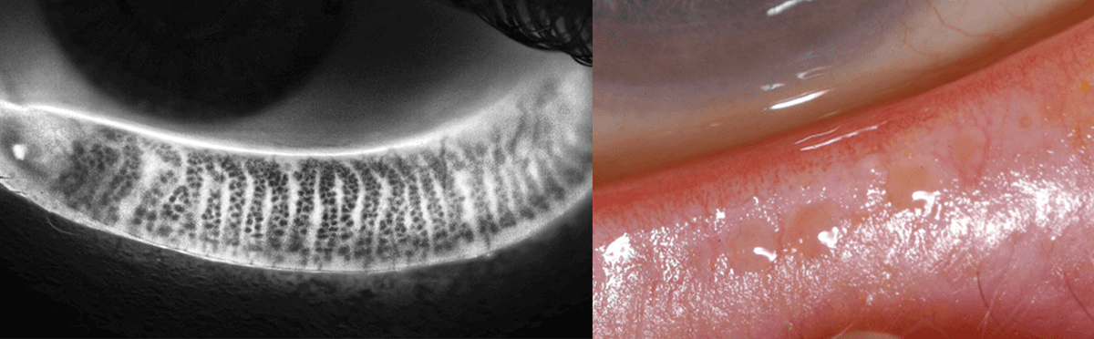 Treating Meibomian Gland Dysfunction With Collaborative Care