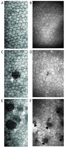Fuchs' Dystrophy and Cataracts: What to Know