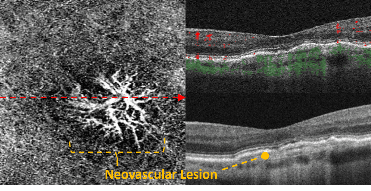 Imaging Neovascular AMD with OCT and OCTA