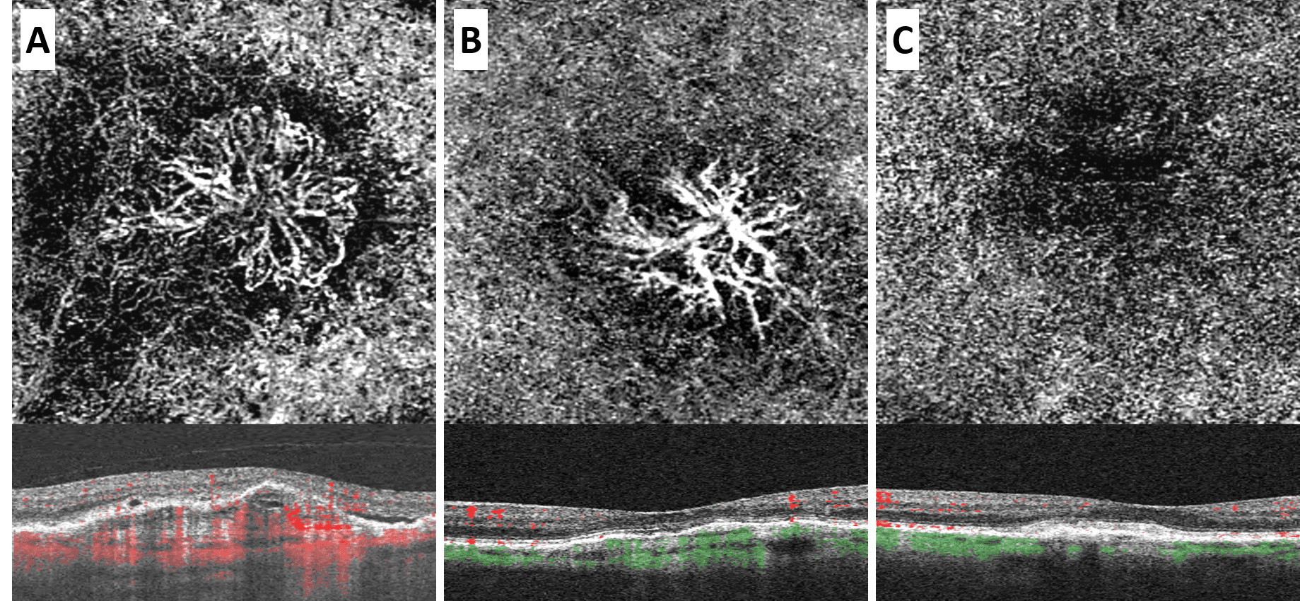 Imaging Neovascular AMD with OCT and OCTA