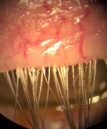 The Ultimate Guide to Demodex Blepharitis