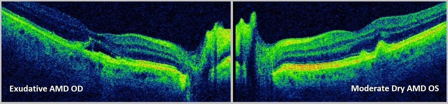 An Introduction to Wet Macular Degeneration for Ophthalmology Residents