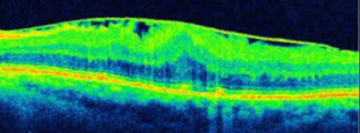 Guide to Common Macula Findings with OCT with Downloadable Cheat Sheet