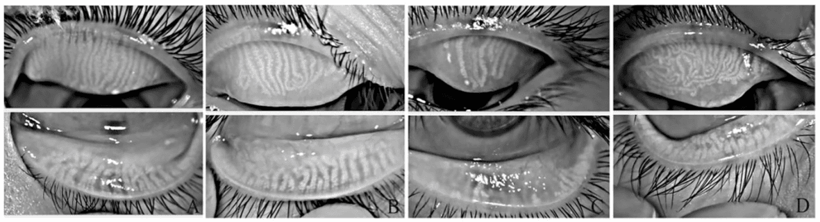 The Link Between Myopia and Dry Eye in Pediatric Patients