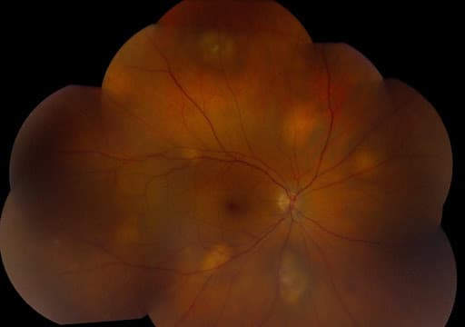Differential Diagnosis for a Pigmented Fundus Lesion with Downloadable ...