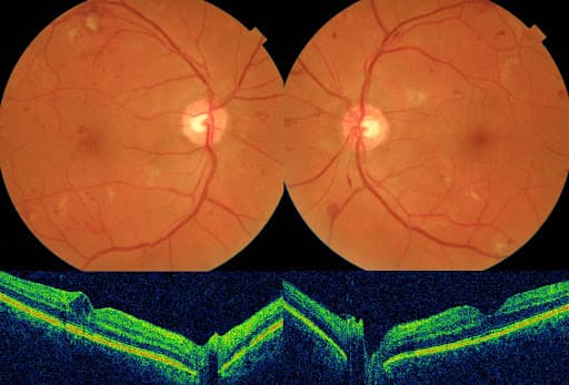 5 Clinical Uses for the Topcon Maestro 3D OCT
